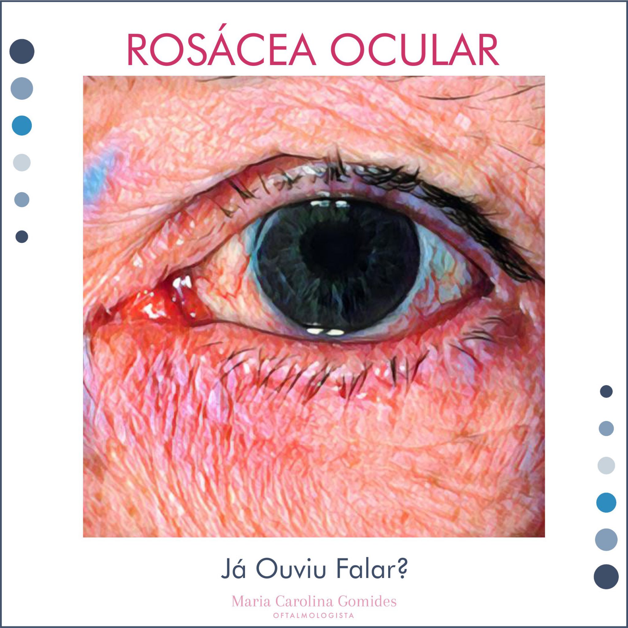Rosácea Ocular – Dra. Carolina Gomides – Oftalmologista São Paulo – SP