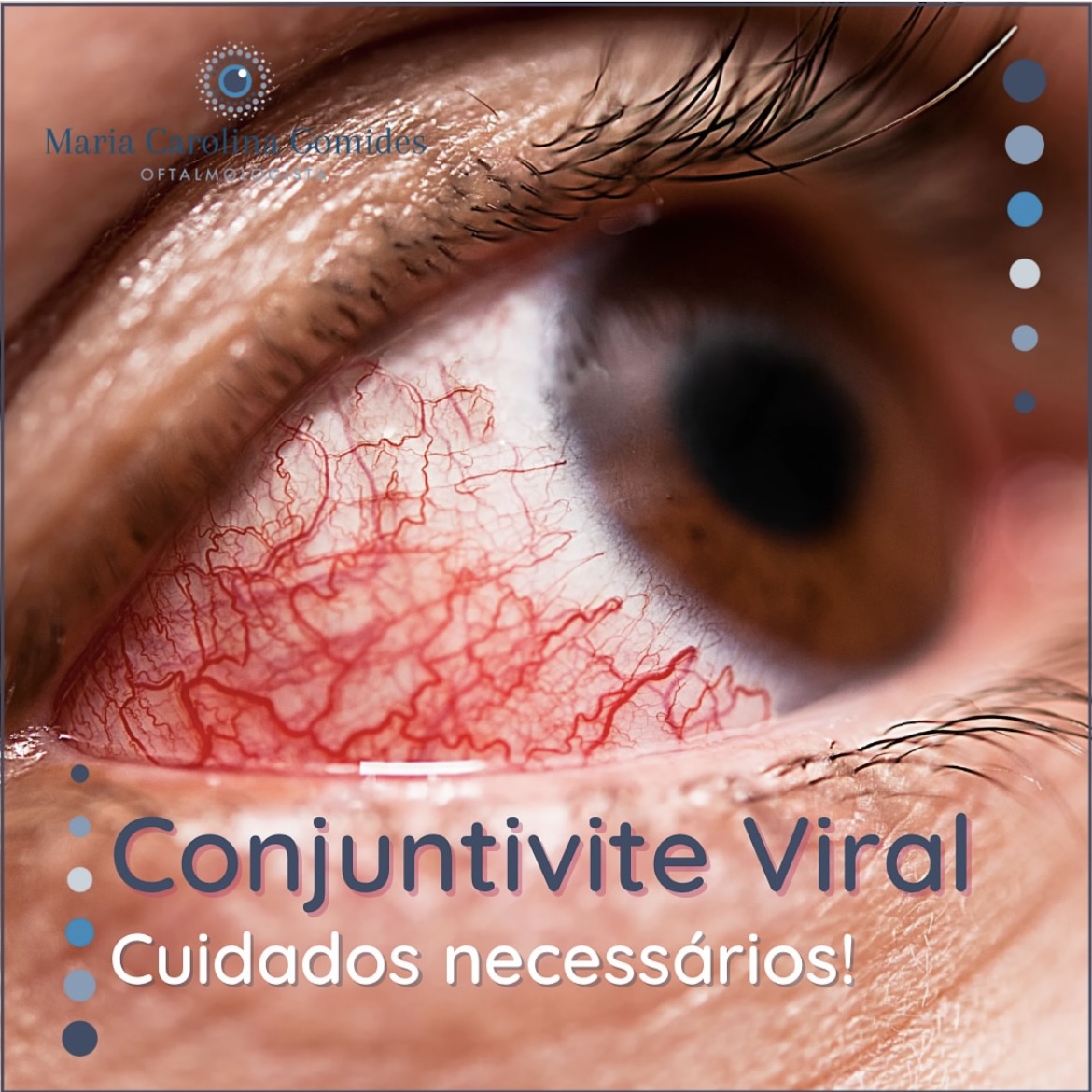 Conjuntivite Viral – Dra. Carolina Gomides – Oftalmologista São Paulo – SP